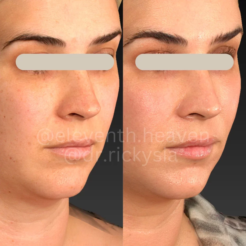 BBL Hero Treatment Brisbane | Skin Rejuvenation Therapy