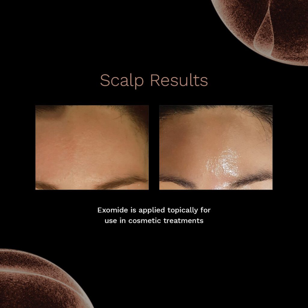 Exosomes | Brisbane Skin Treatments